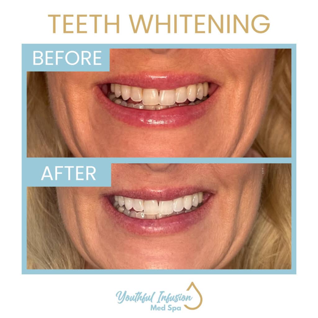 Teeth Whitening | Youthful Infusion Med Spa | Allen, TX