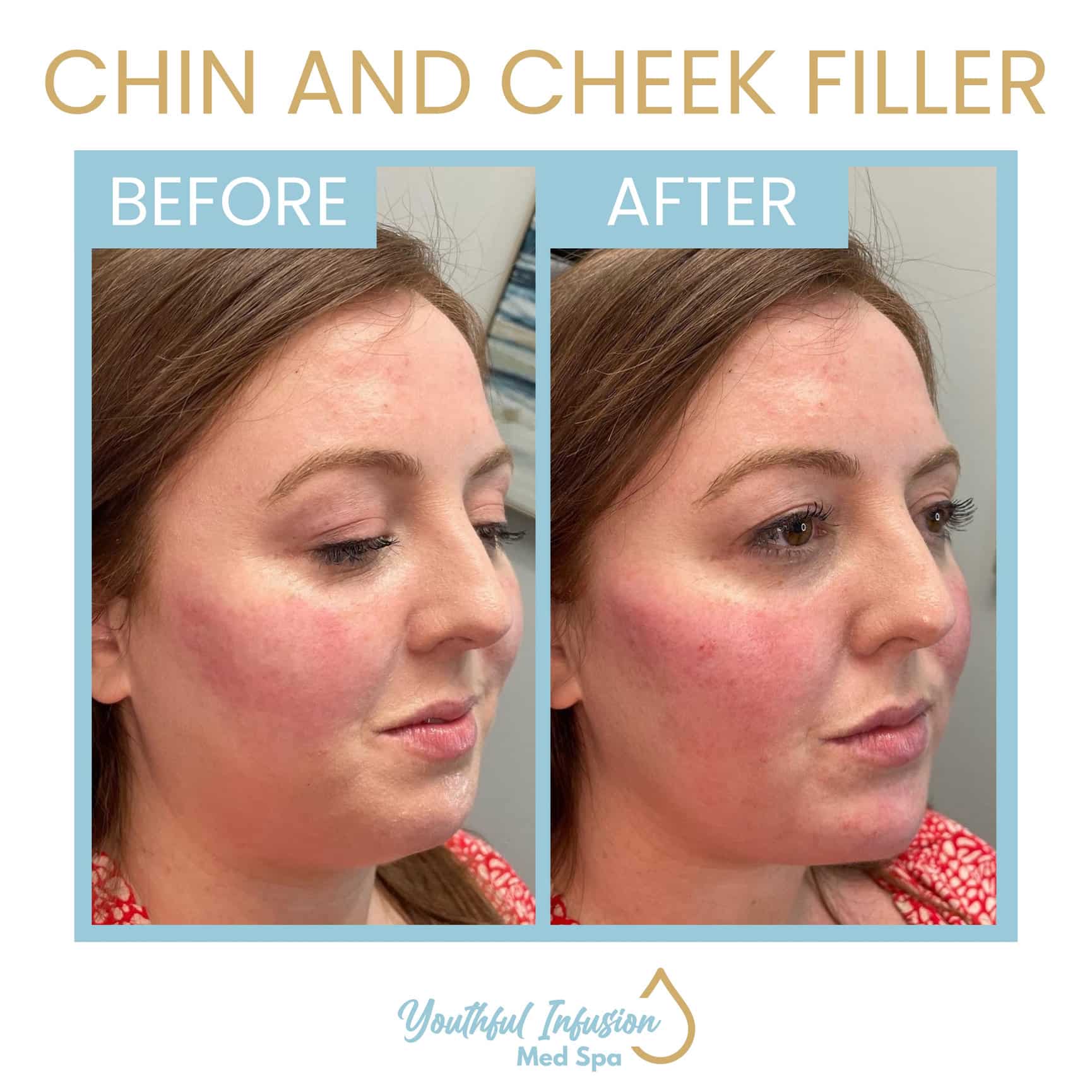 CHIN AND CHEEK DERMAL FILLERS - Youthful Infusion Med Spa