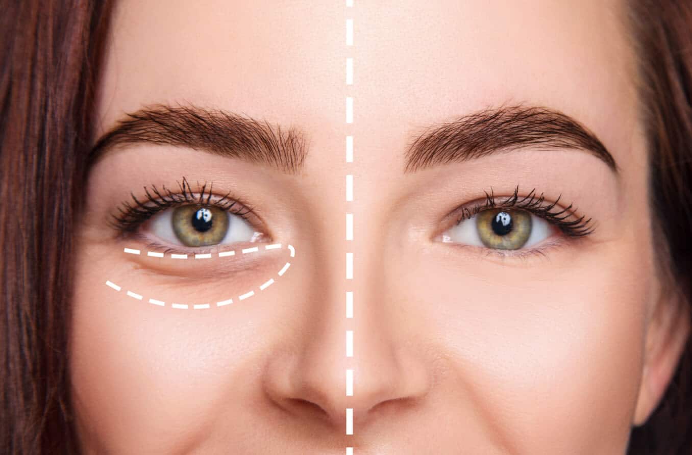 What Are Under Eye Fillers? - Youthful Infusion Med Spa